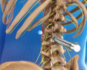 Complex Regional Pain Syndrome | Dayton Outpatient Center